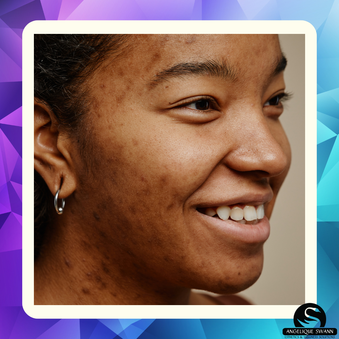 Adult Acne: Understanding the Root Causes & Clearing Your Skin ...