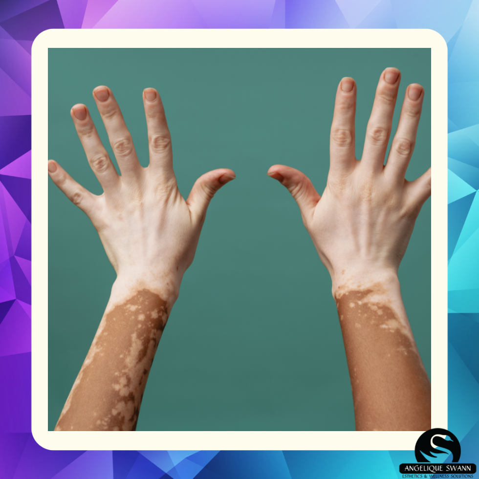 Tinea Versicolor vs. Vitiligo: Understanding the Differences ...